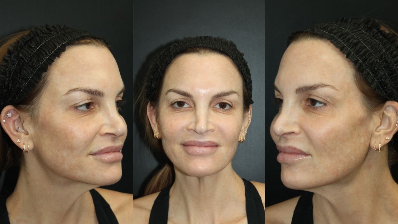 Healing Post-CO2 Laser Using MTP Technology